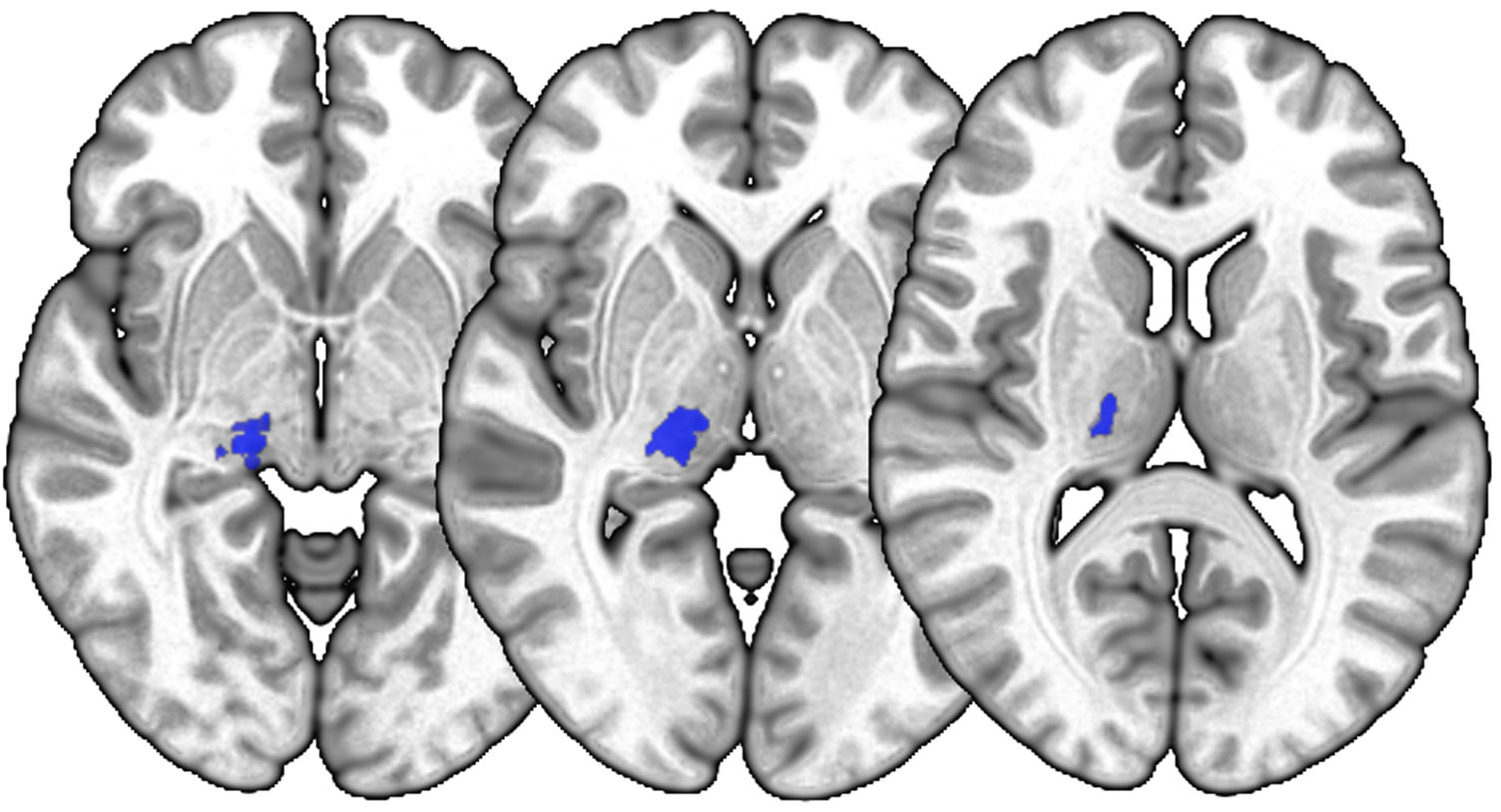 Thalamic-3 Lateral Core – Stroke Maps