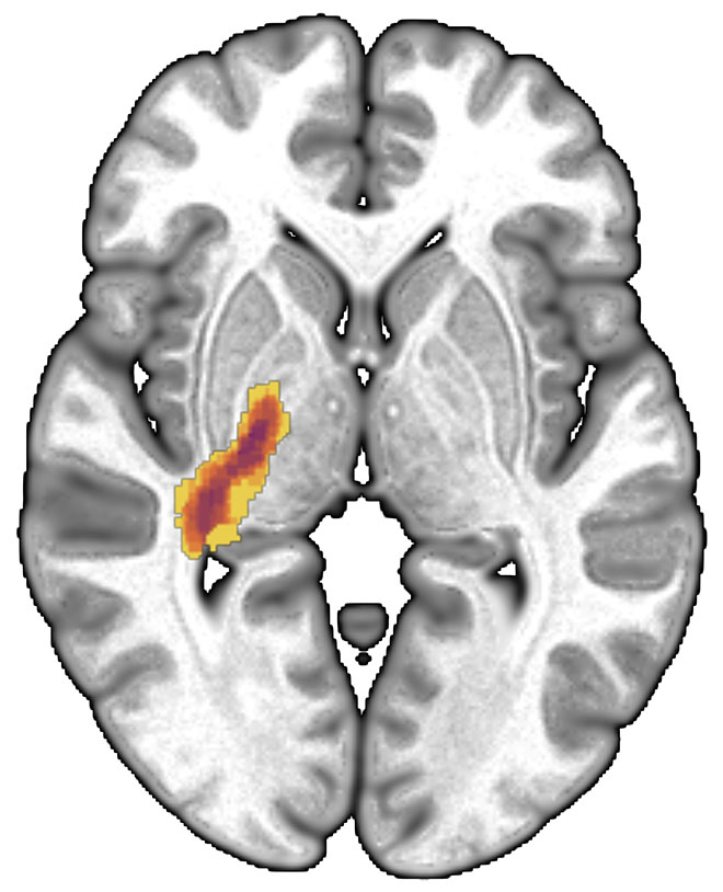 Anterior Choroidal – Stroke Maps