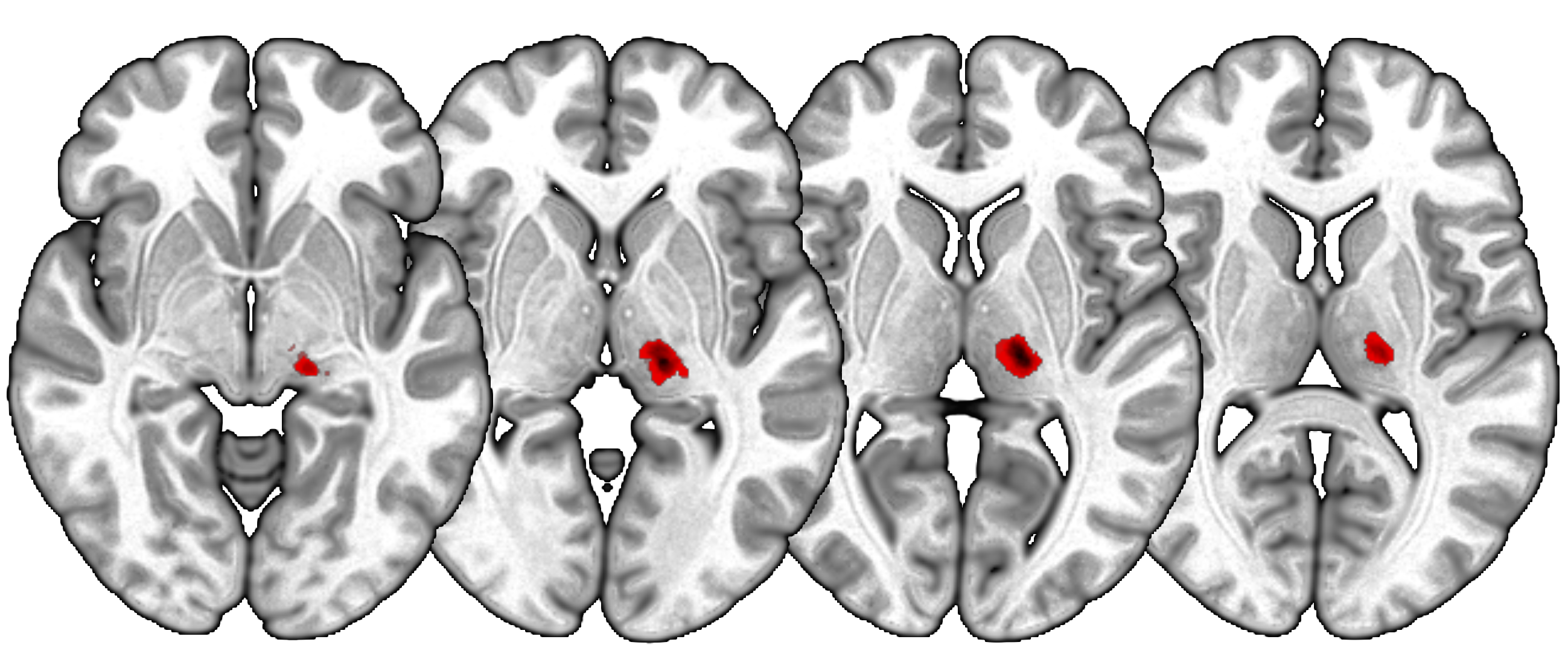 Lateral Thalamic – Stroke Maps