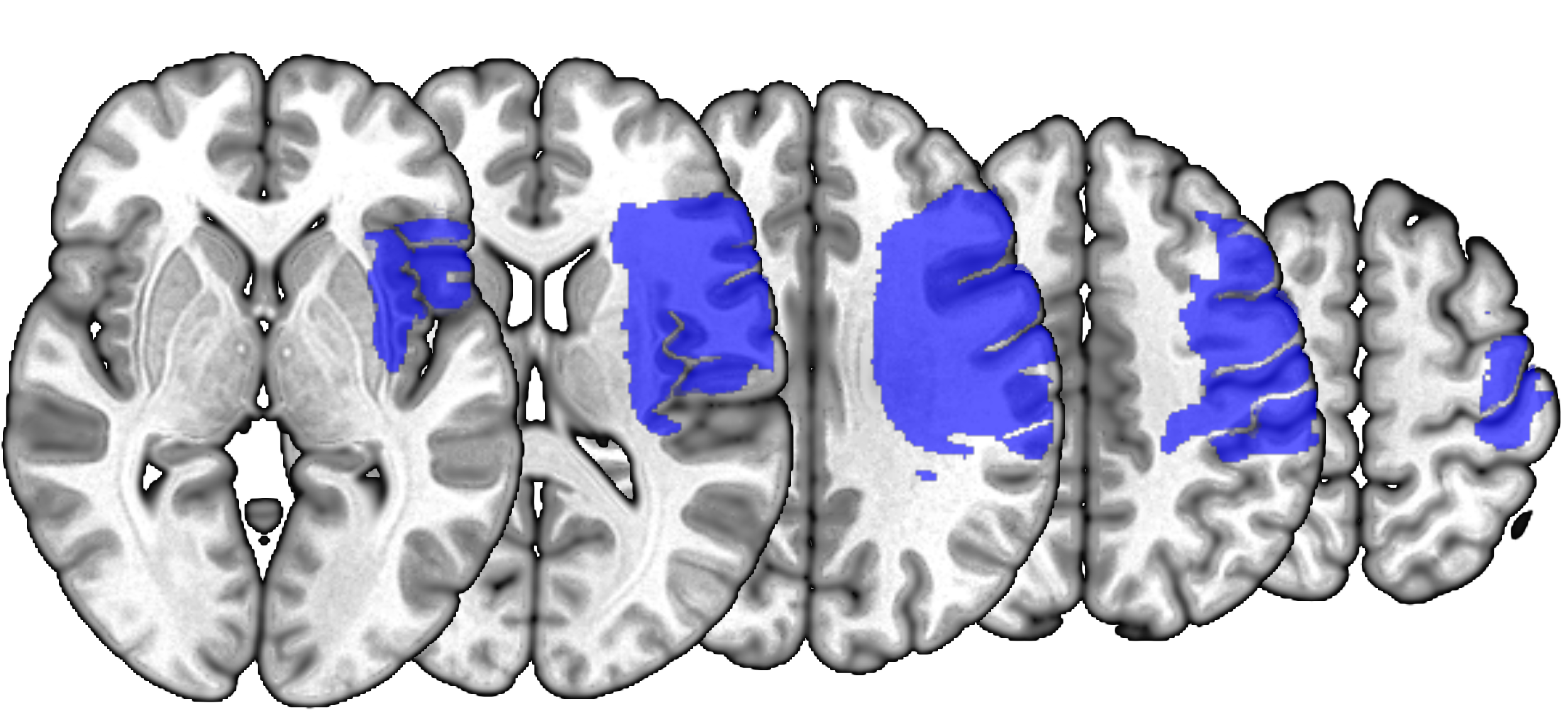 Clinical – Stroke Maps